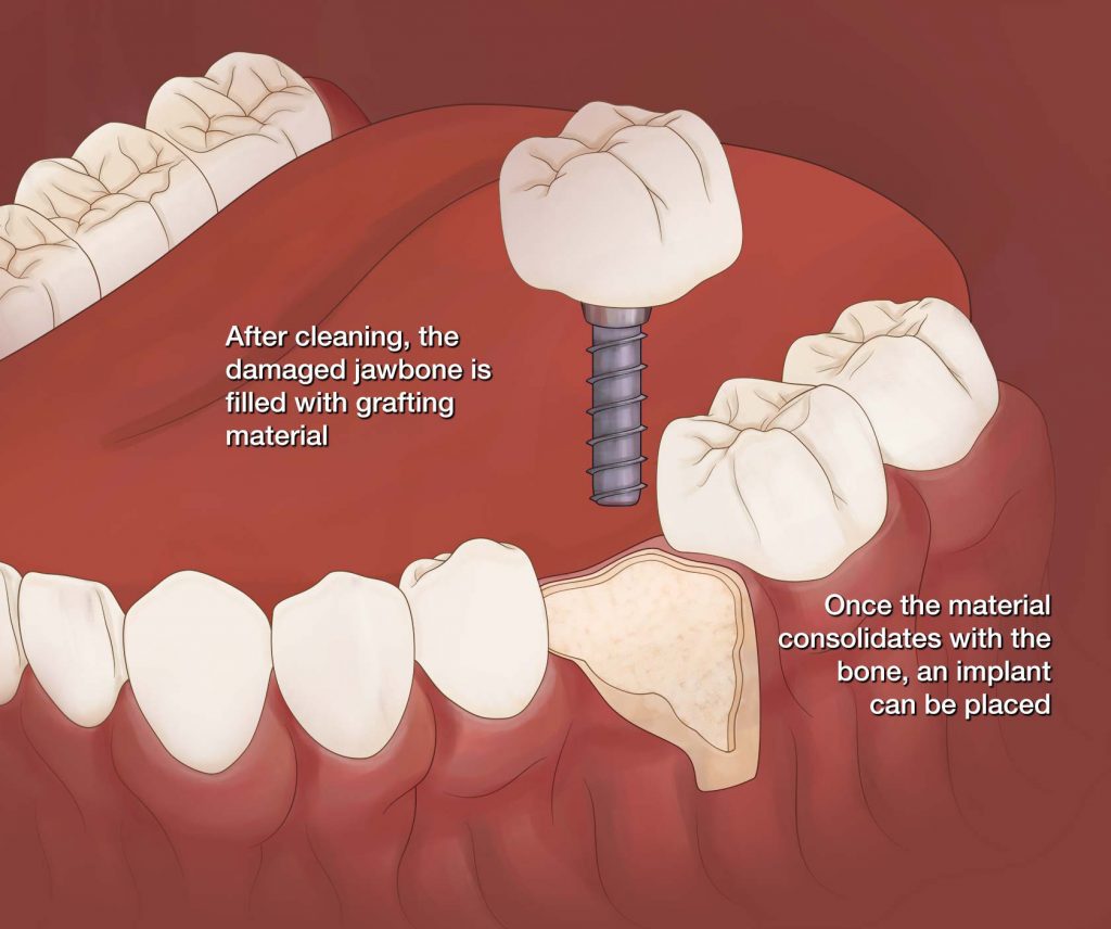Bone Graft - Desert Dental Nogales